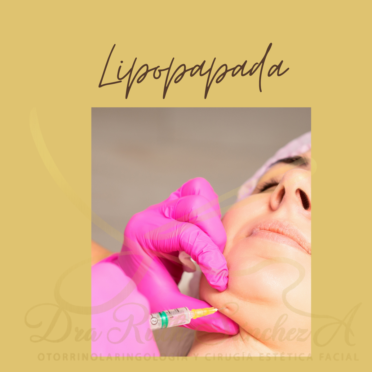 LIPOSUCCION DE CUELLO Y PAPADA – Dra. Ruth Sánchez
